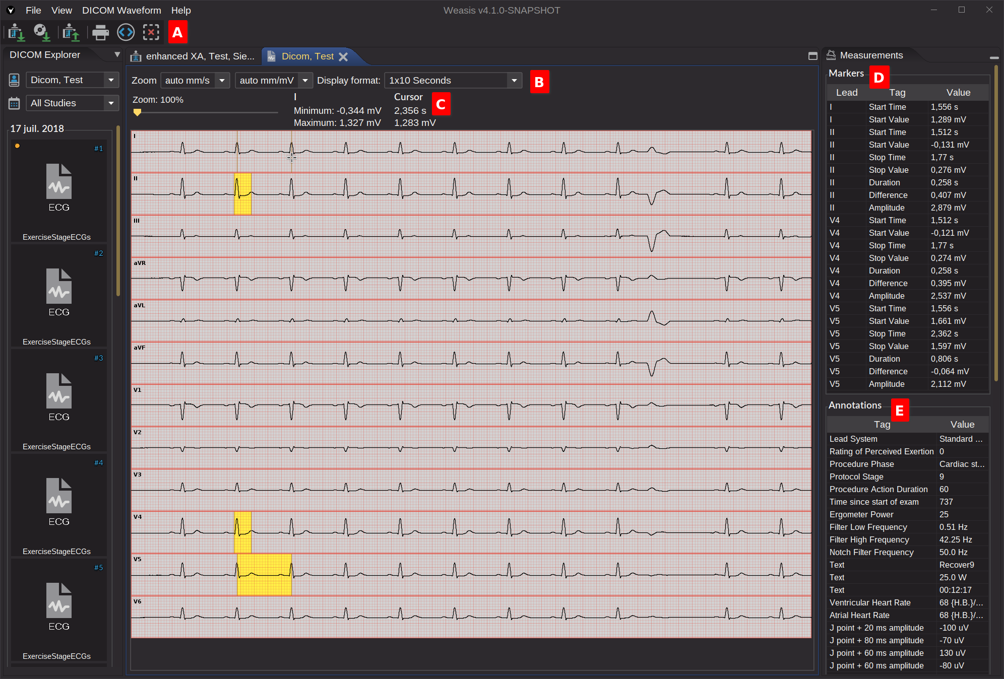 DICOM ECG Viewer :: Weasis Documentation DICOM ECG Viewer :: Weasis Documentation